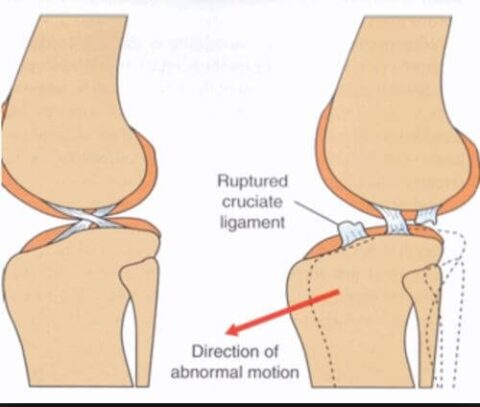 Why Choose MMP Over TPLO For Cranial Cruciate Ligament Tear Of The Dog ...